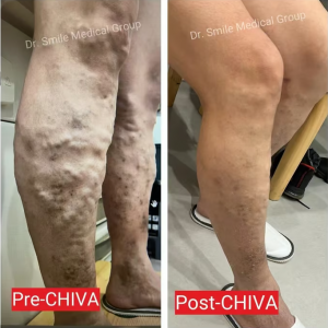 医疗服务-下肢静脉曲张CHIVA治疗 – 张强医生集团 Dr. Smile Medical Group 官方网站